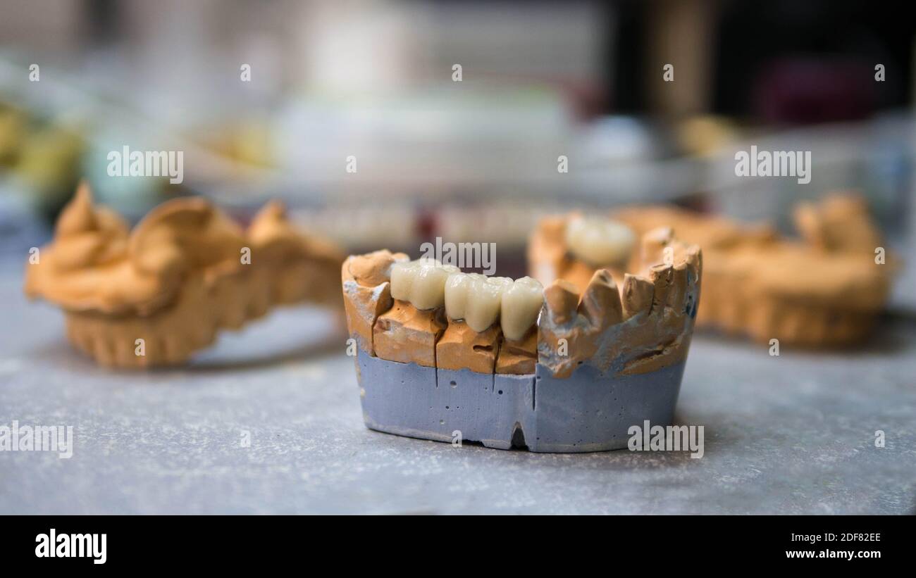 Plaster model of teeth on a work table,a dental technician makes a ...