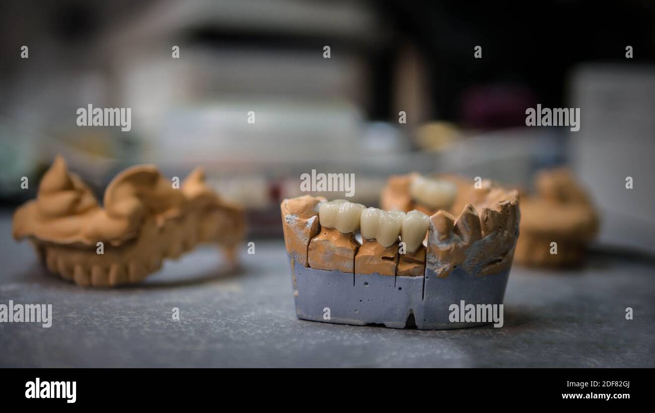 Plaster model of teeth on a work table,a dental technician makes a ...