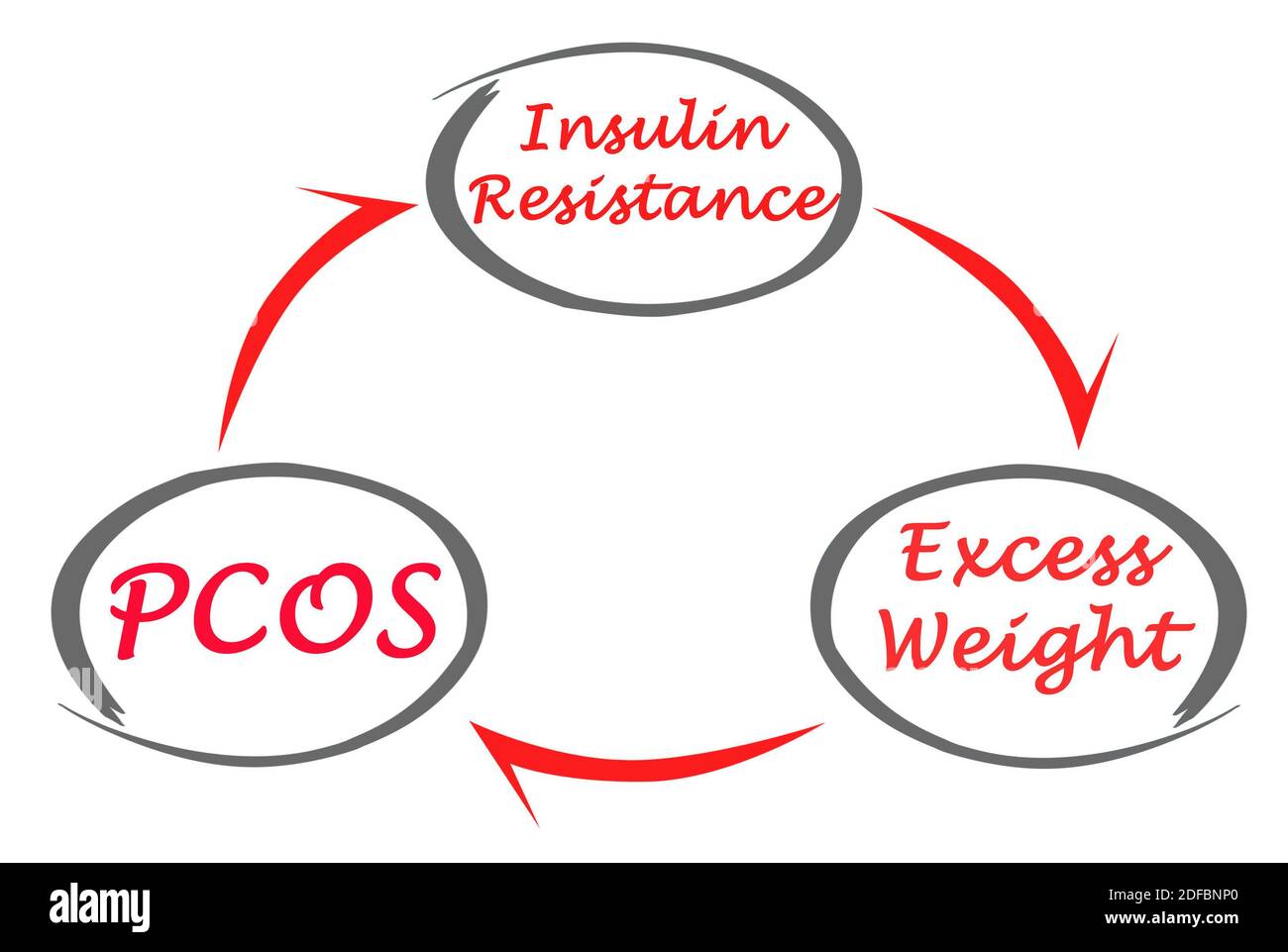 Cycle of Polycystic ovary syndrome (PCOS Stock Photo - Alamy
