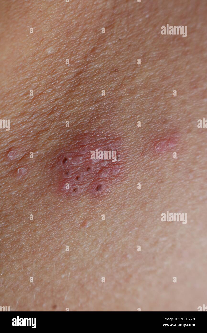 Shingles rash hi-res stock photography and images - Alamy