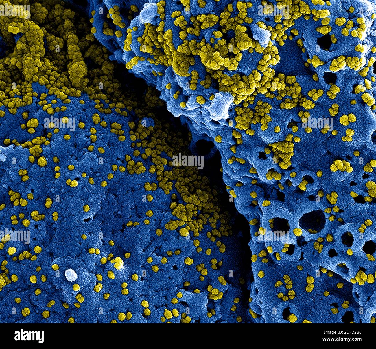 Colorized scanning electron micrograph of MERS virus particles (yellow ...
