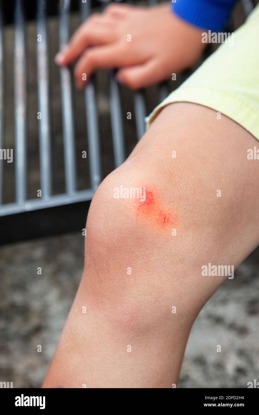 Child hurt knee outdoors hi-res stock photography and images - Alamy