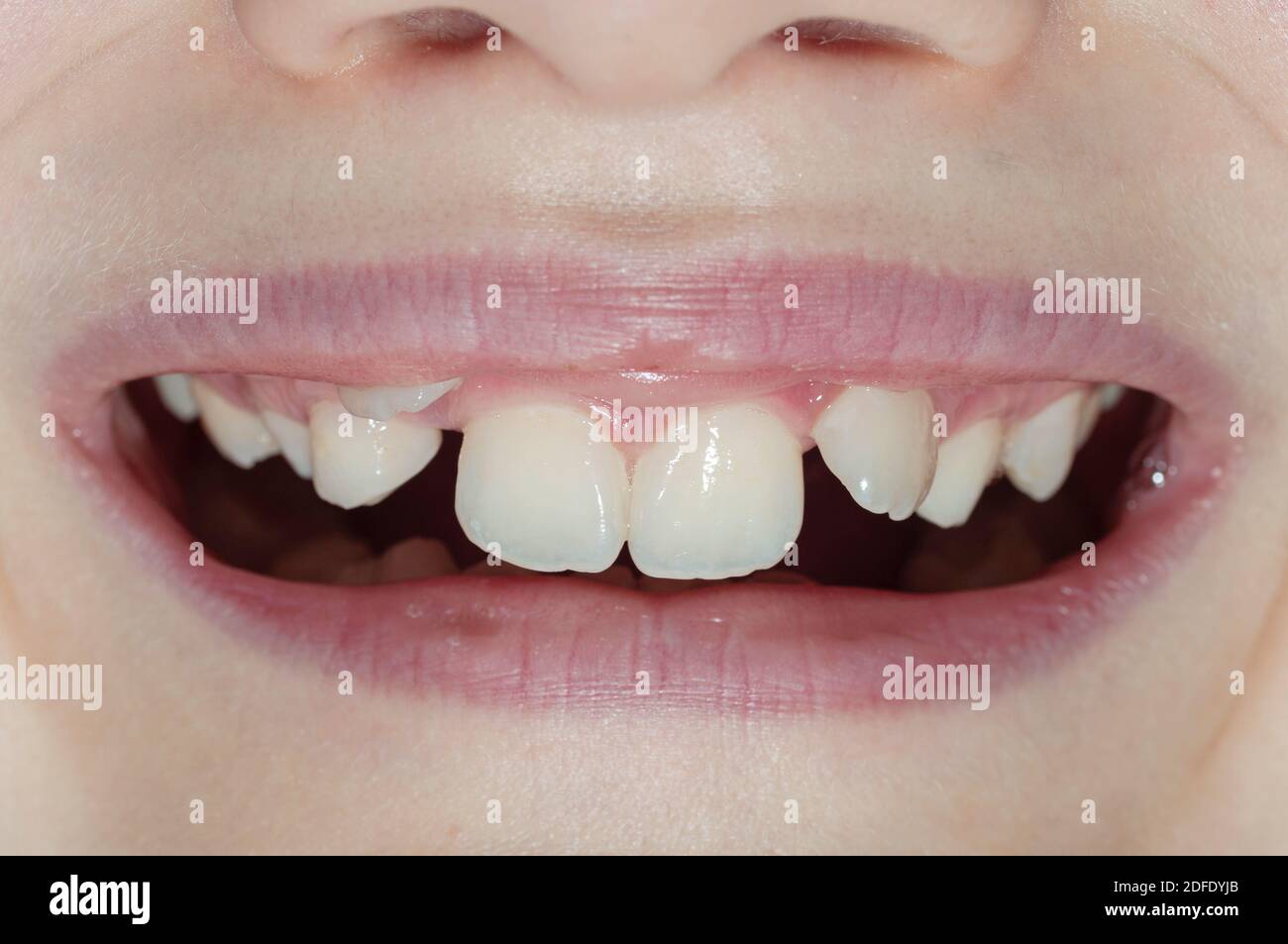 Boy mouth open teeth hi-res stock photography and images - Alamy