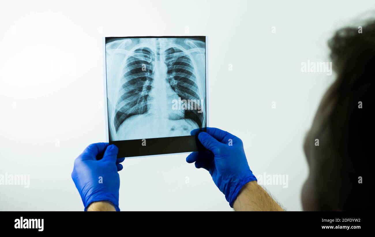 X-ray of human lungs in the hand of a doctor, the diagnosis of ...