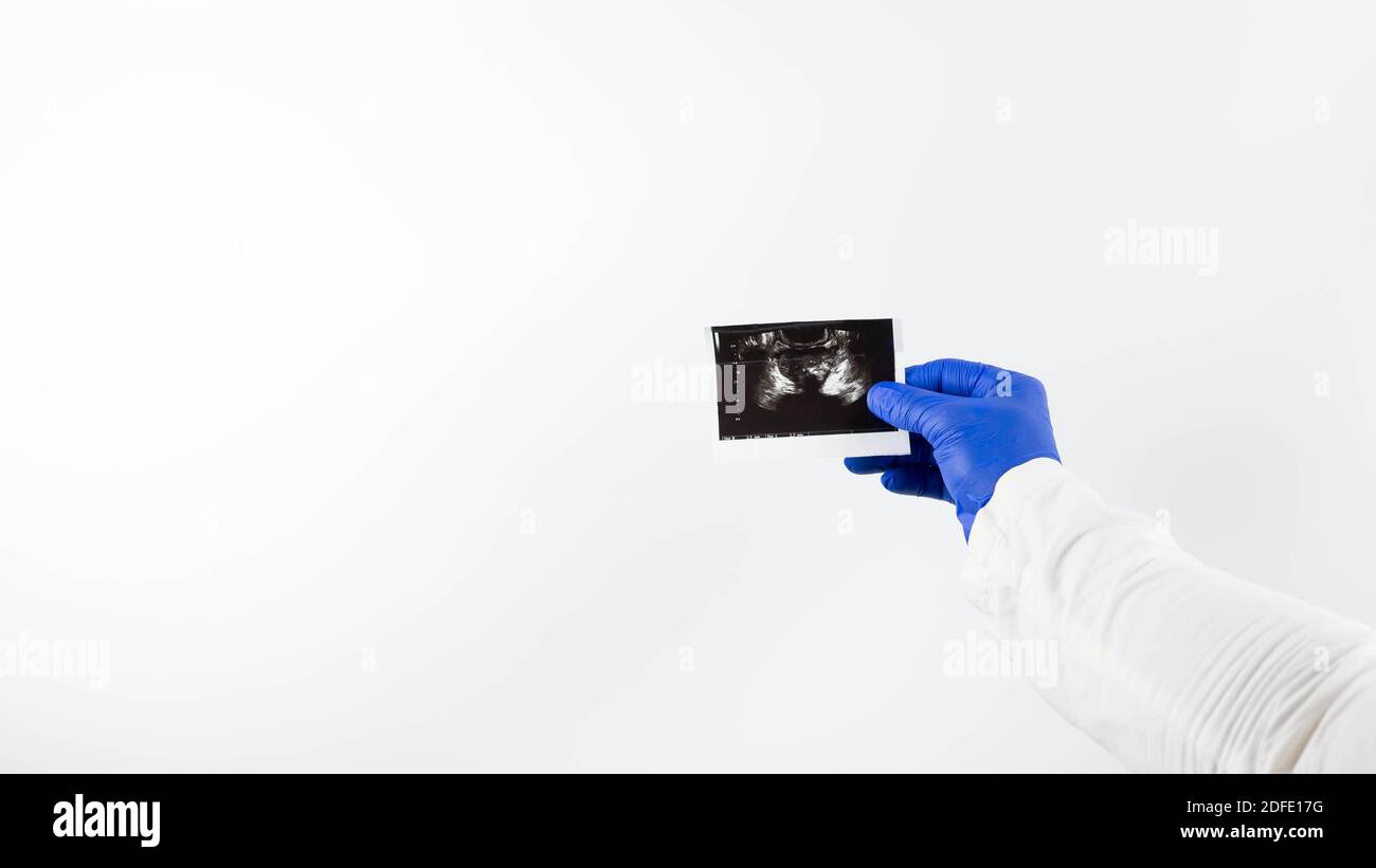 Bladder cancer ultrasound hi-res stock photography and images - Alamy