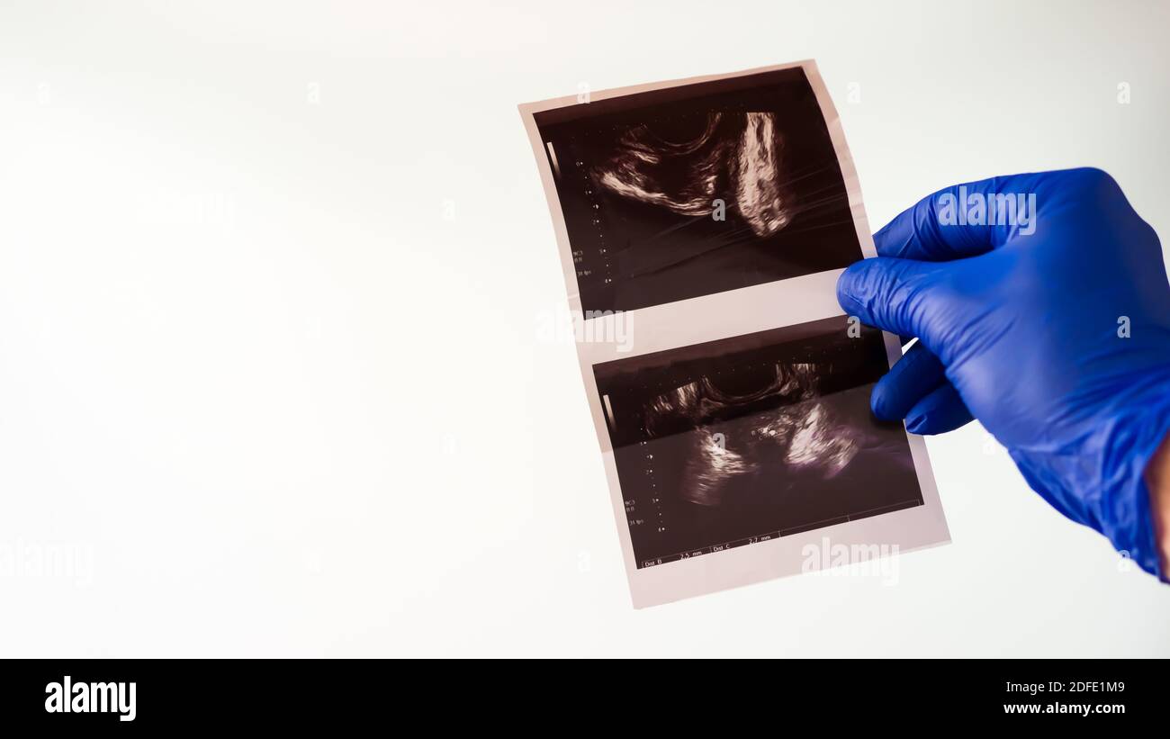 Transrectal ultrasound of the prostate.The doctor examines the patient ...