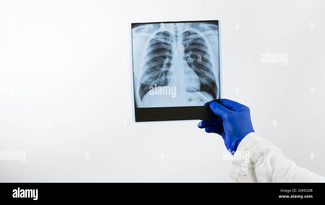 Chest X-rays on negatoscope. Negatoscope isolated on white background ...