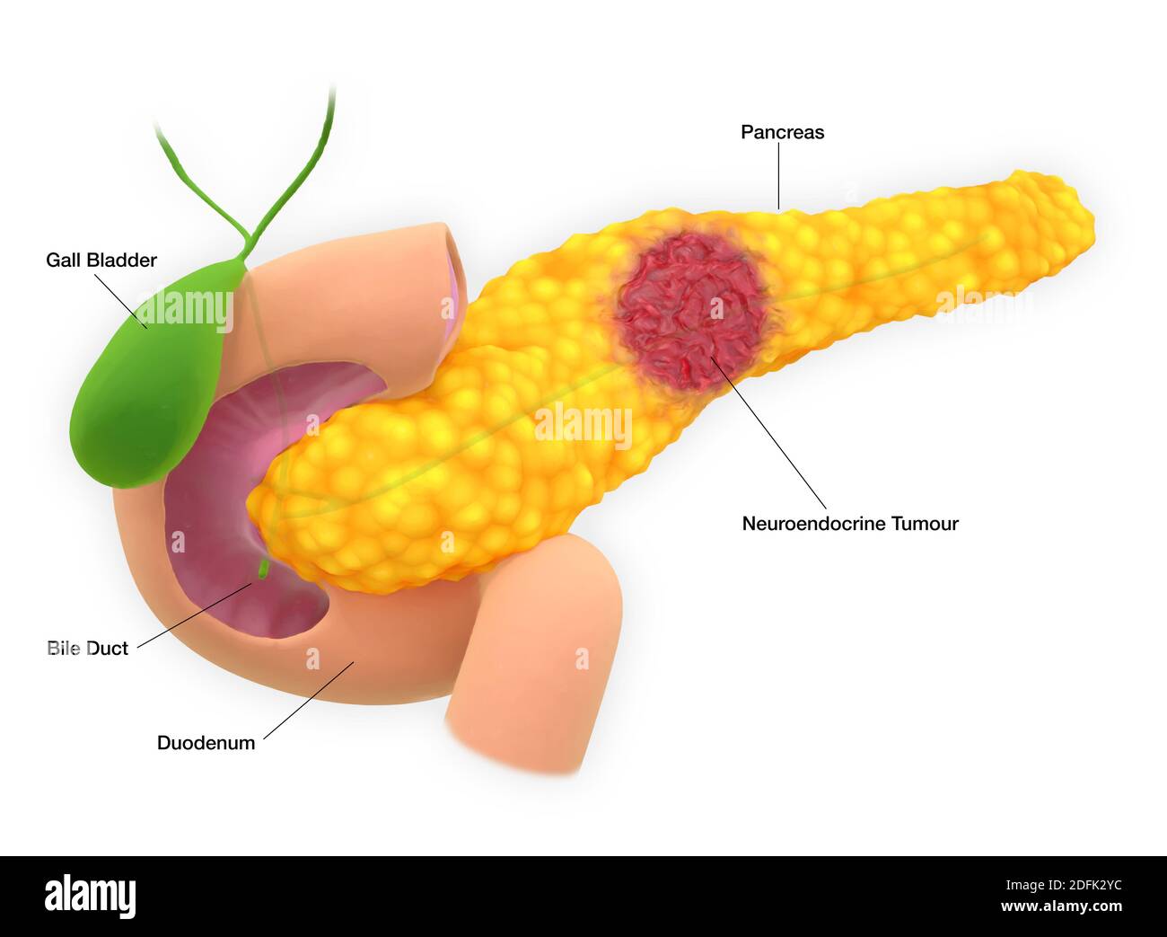 Pancreatic neuroendocrine tumour, illustration Stock Photo - Alamy