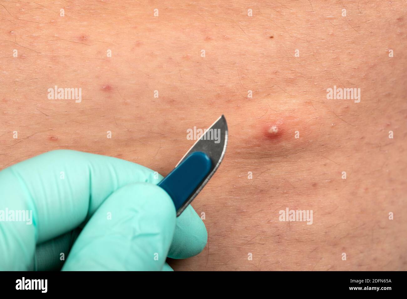 Close up picture of doctor's hands holding sterile scalpel next to ...