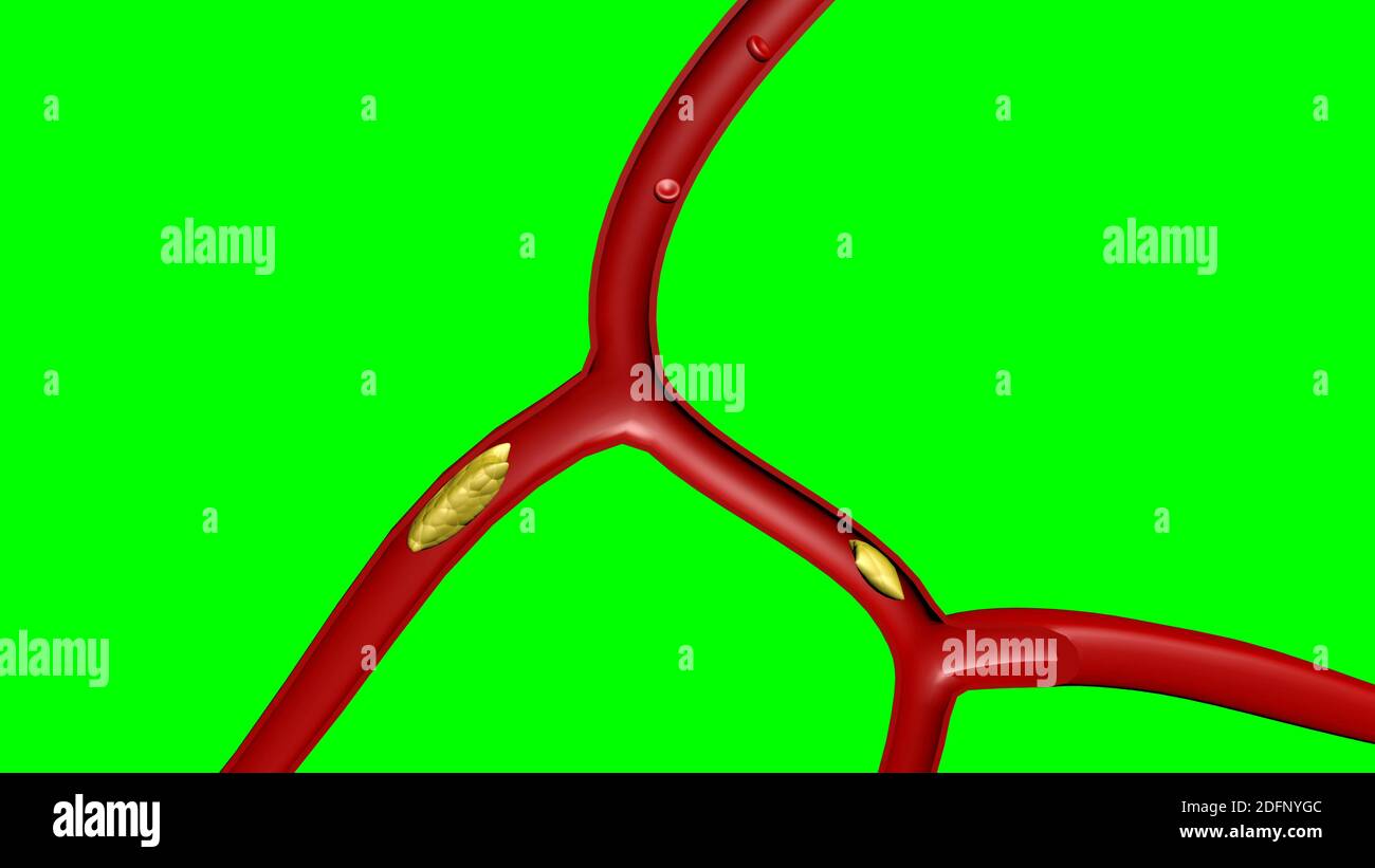 3d blood cell cholesterol clot medical design on green screen 3d render ...