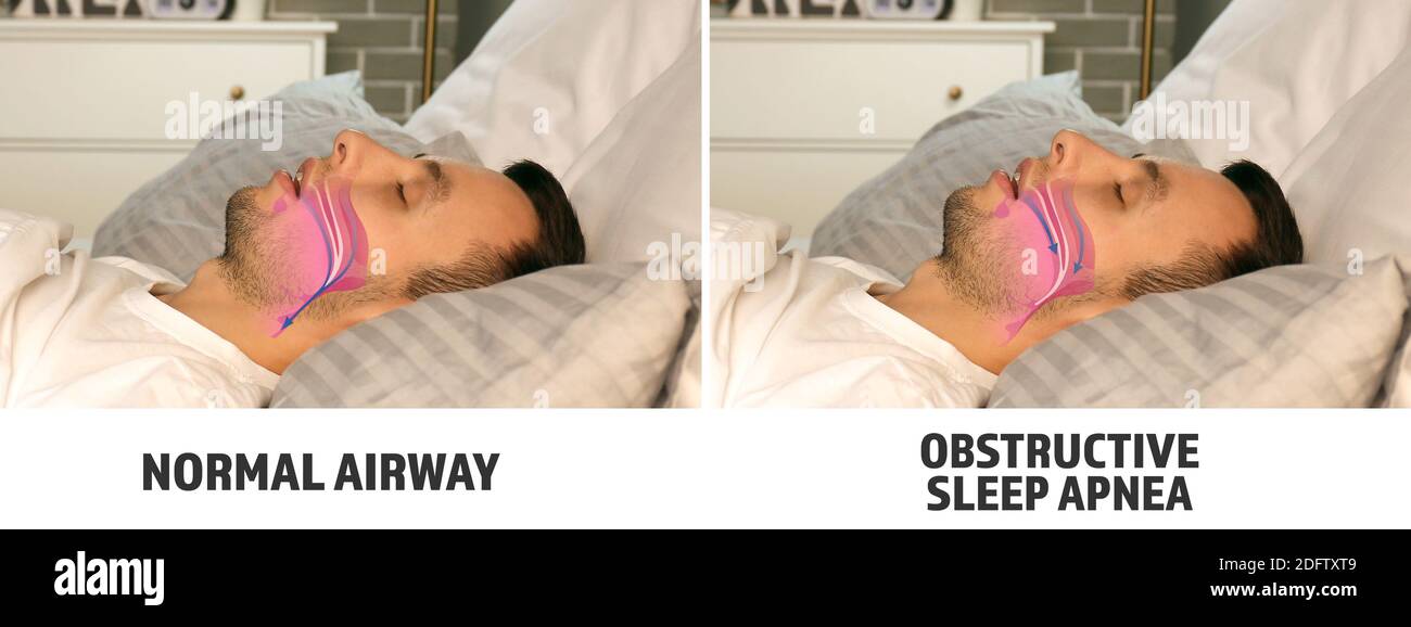 Illustrations showing difference between normal breathing and ...