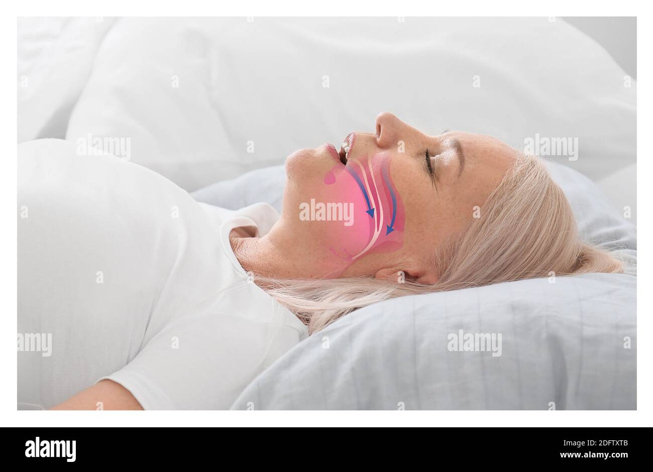 Illustration showing airway during obstructive sleep apnea Stock Photo ...