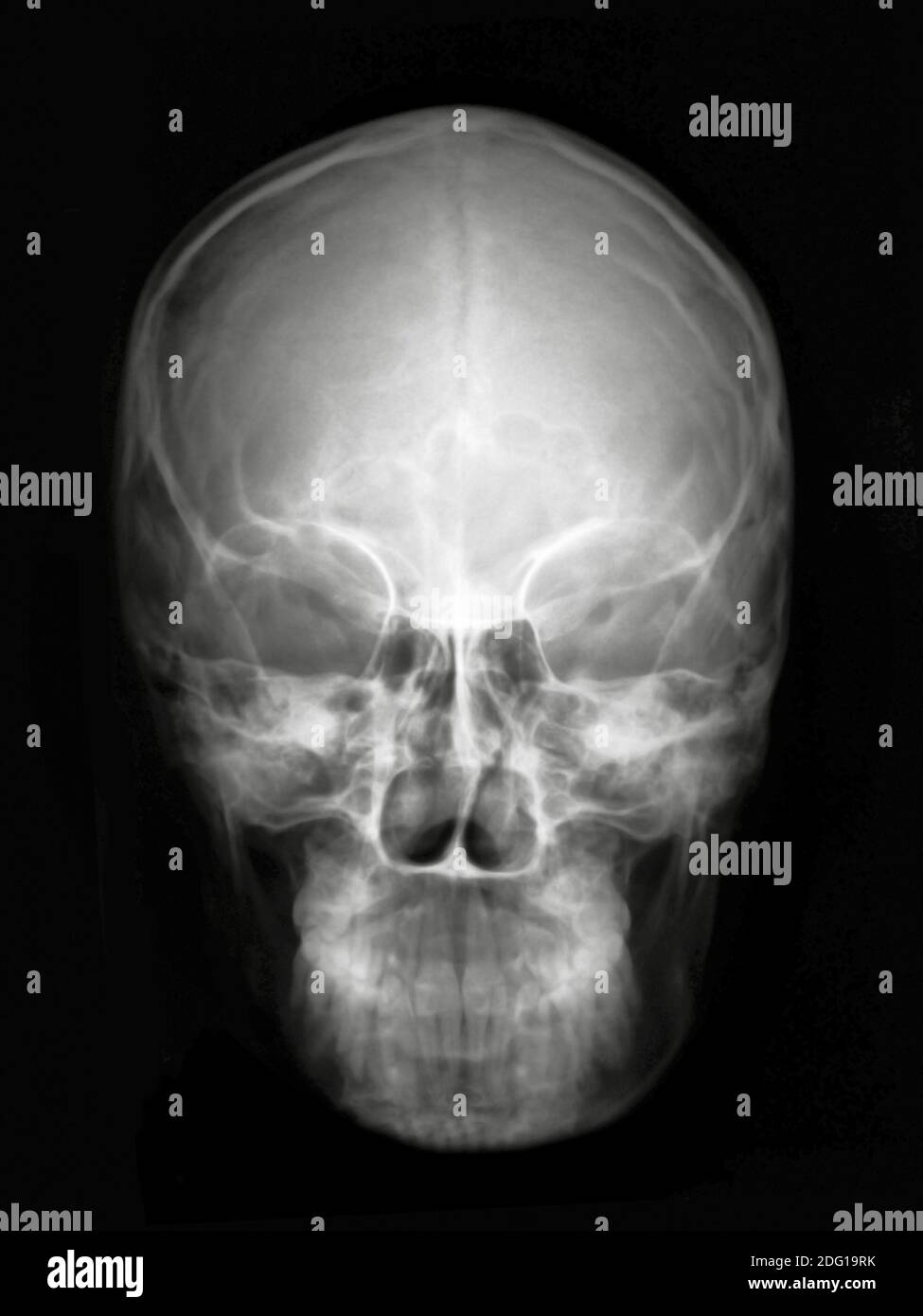 X ray Head Stock Photo - Alamy