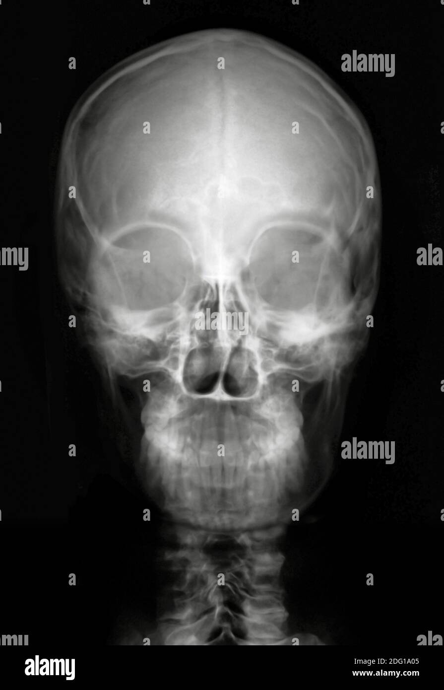 Head radiography hi-res stock photography and images - Alamy