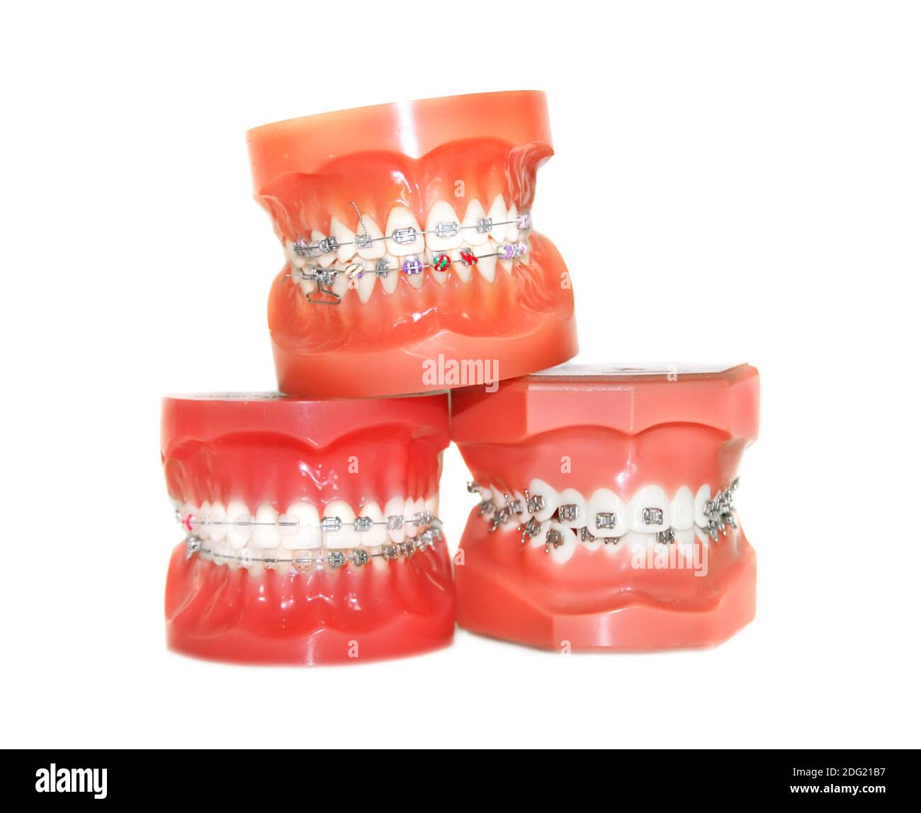 Teeth with braces isolated Stock Photo - Alamy