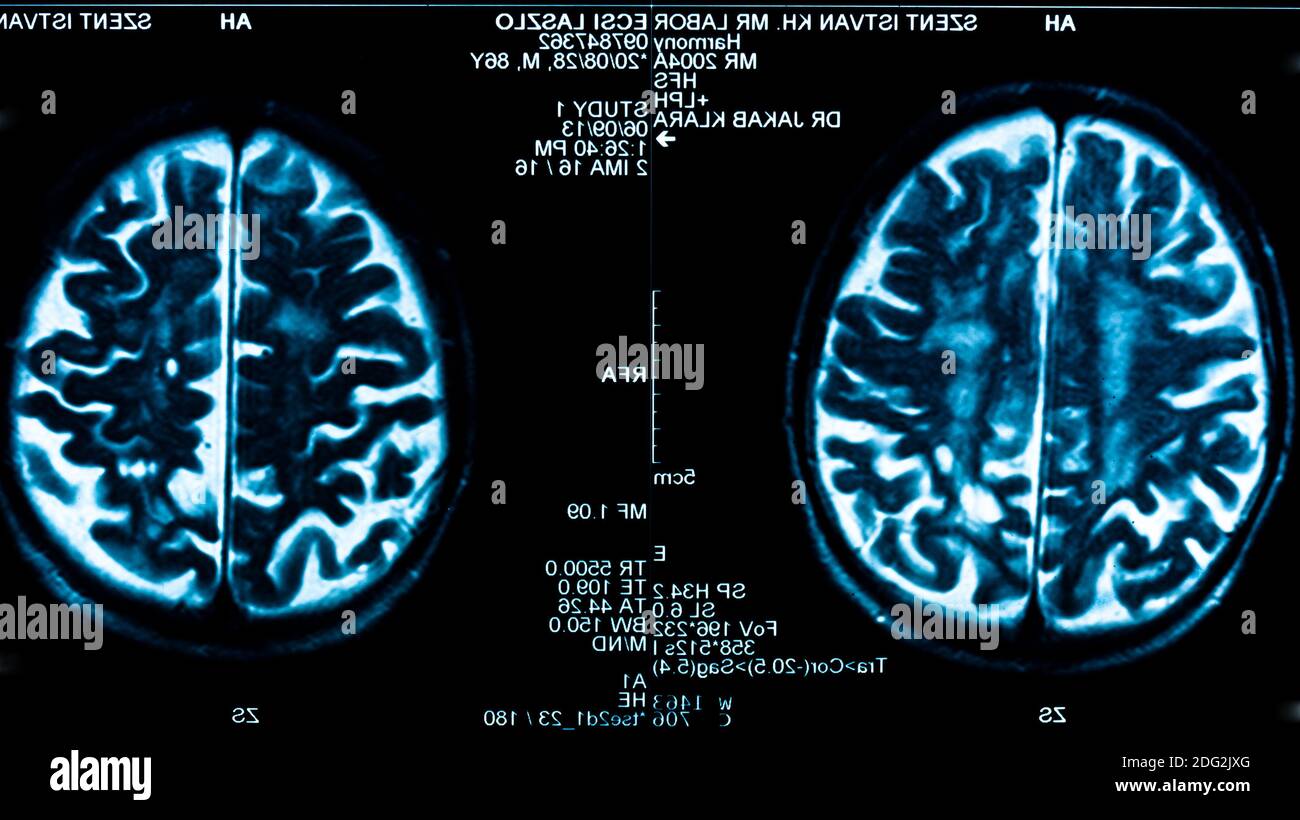 Neuron test hi-res stock photography and images - Alamy