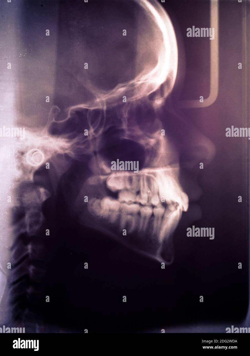 Ct scan skull injury hi-res stock photography and images - Alamy