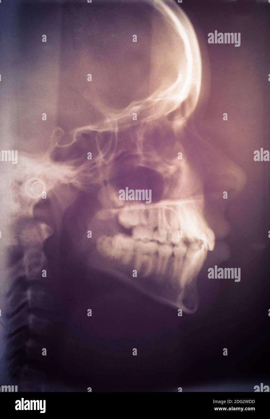 Ct scan skull injury hi-res stock photography and images - Alamy