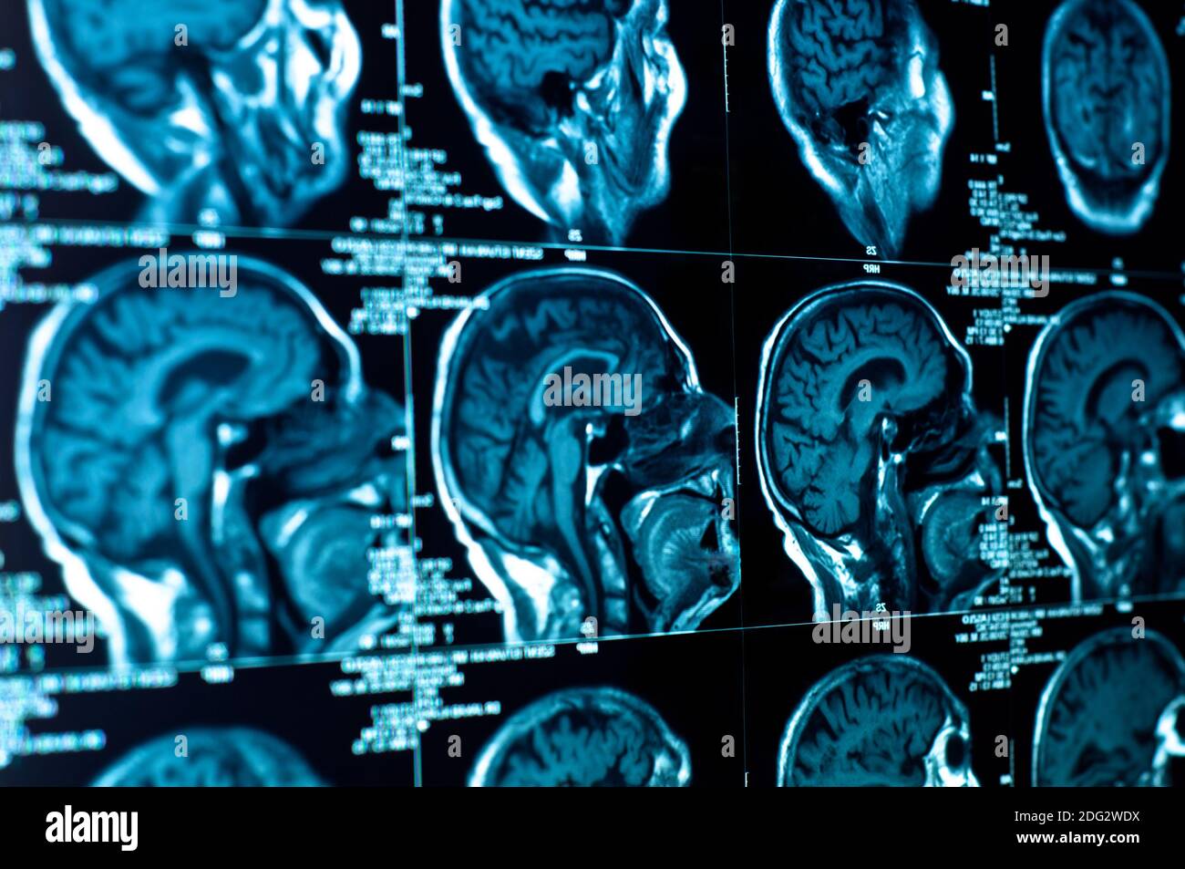 Mri of top brain hi-res stock photography and images - Alamy