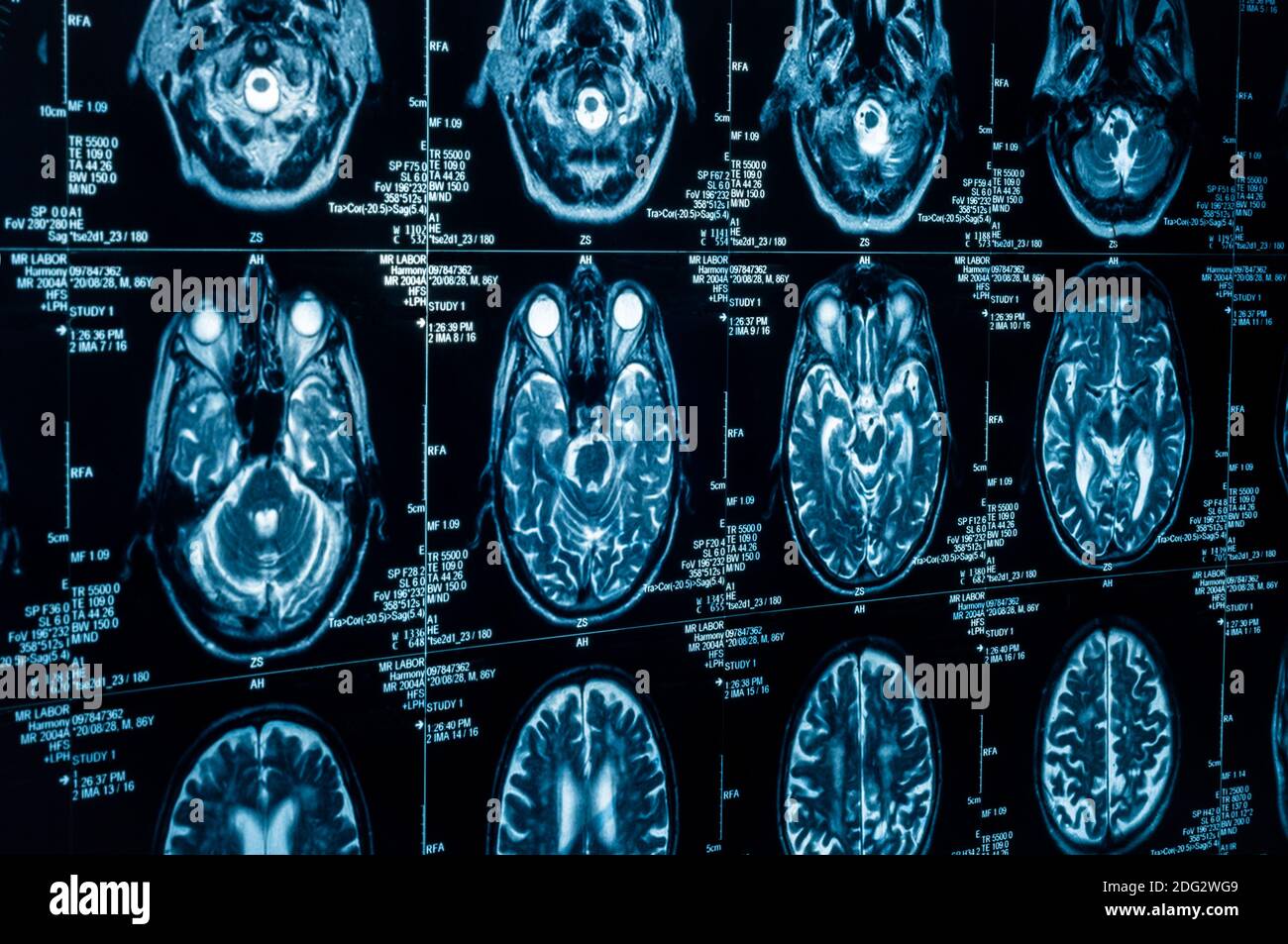 Mri scans of brain hi-res stock photography and images - Alamy