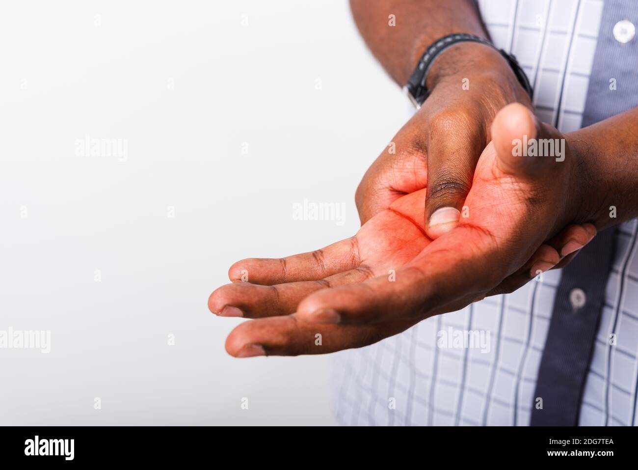Closeup hand Asian black man holds his palm hand injury, feeling pain ...