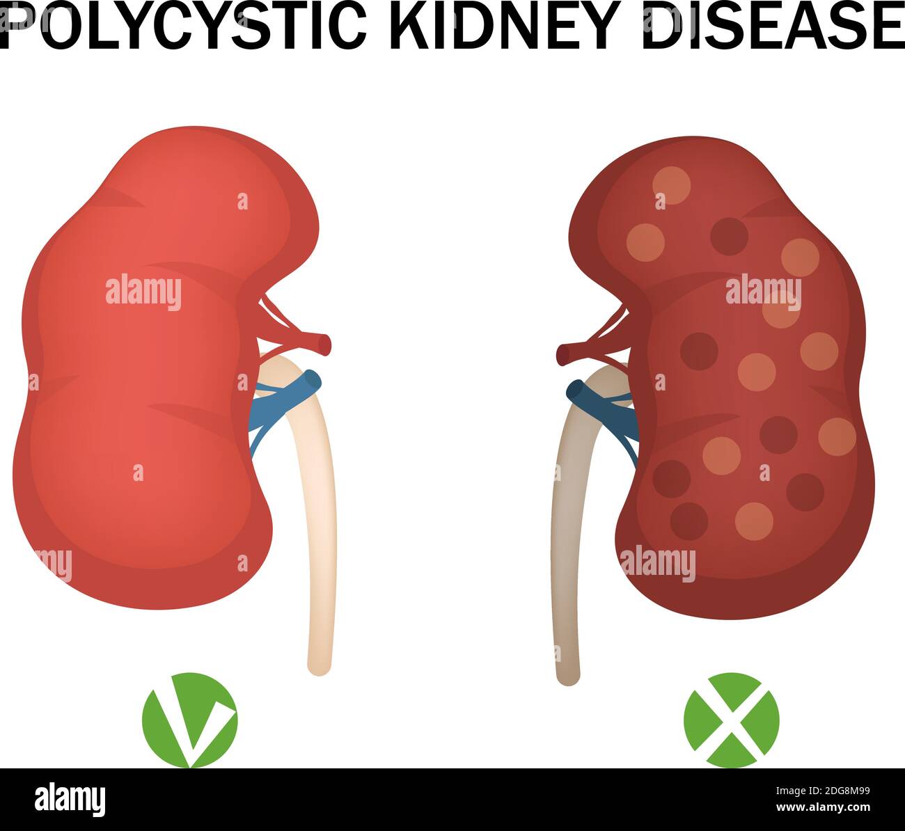 Polycystic kidney disease and healthy kidney. medical infographics ...
