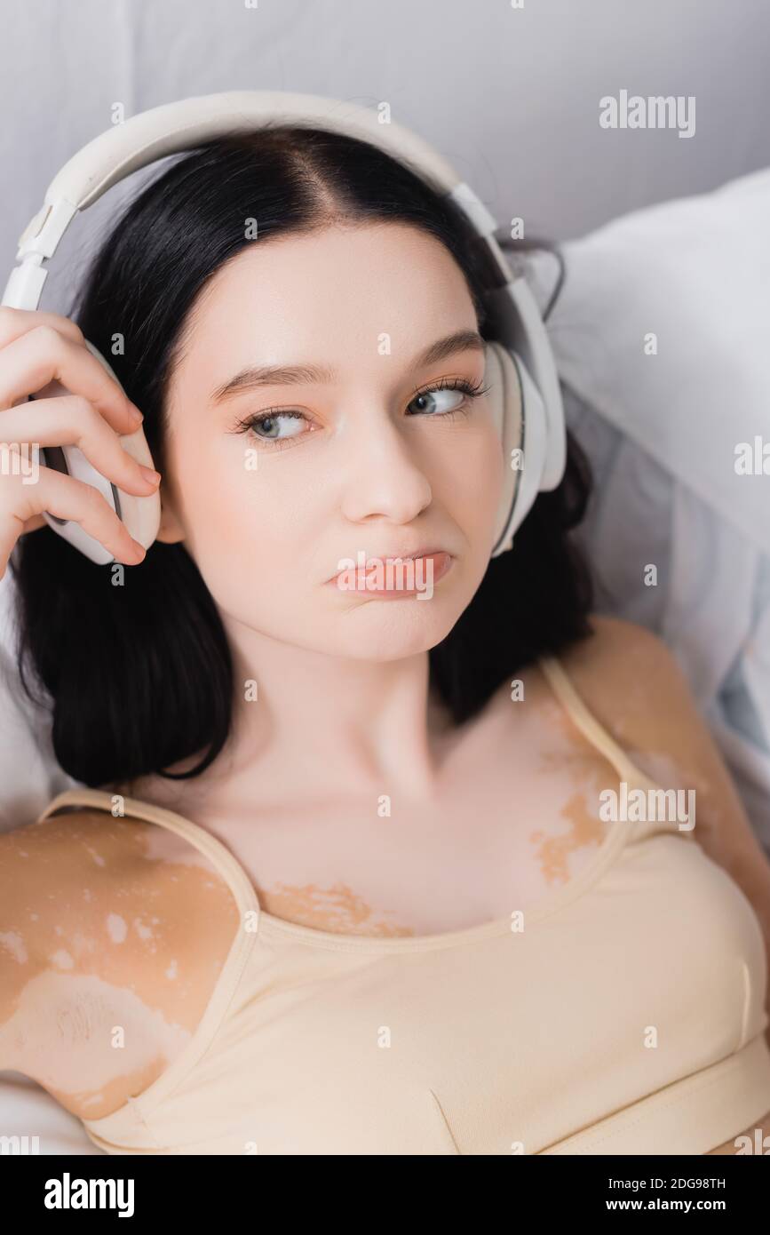 sad young woman with vitiligo adjusting wireless headphones Stock Photo ...