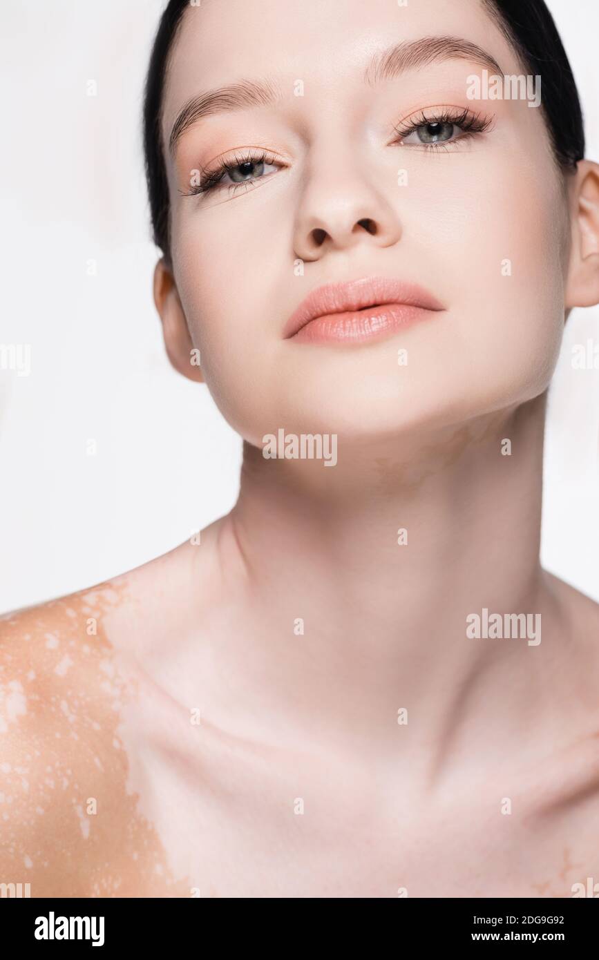 portrait of young beautiful woman with vitiligo isolated on white Stock ...