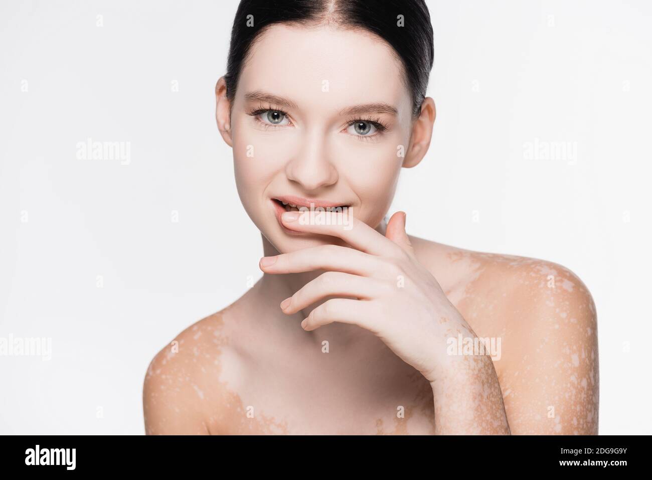 young beautiful woman with vitiligo isolated on white Stock Photo - Alamy