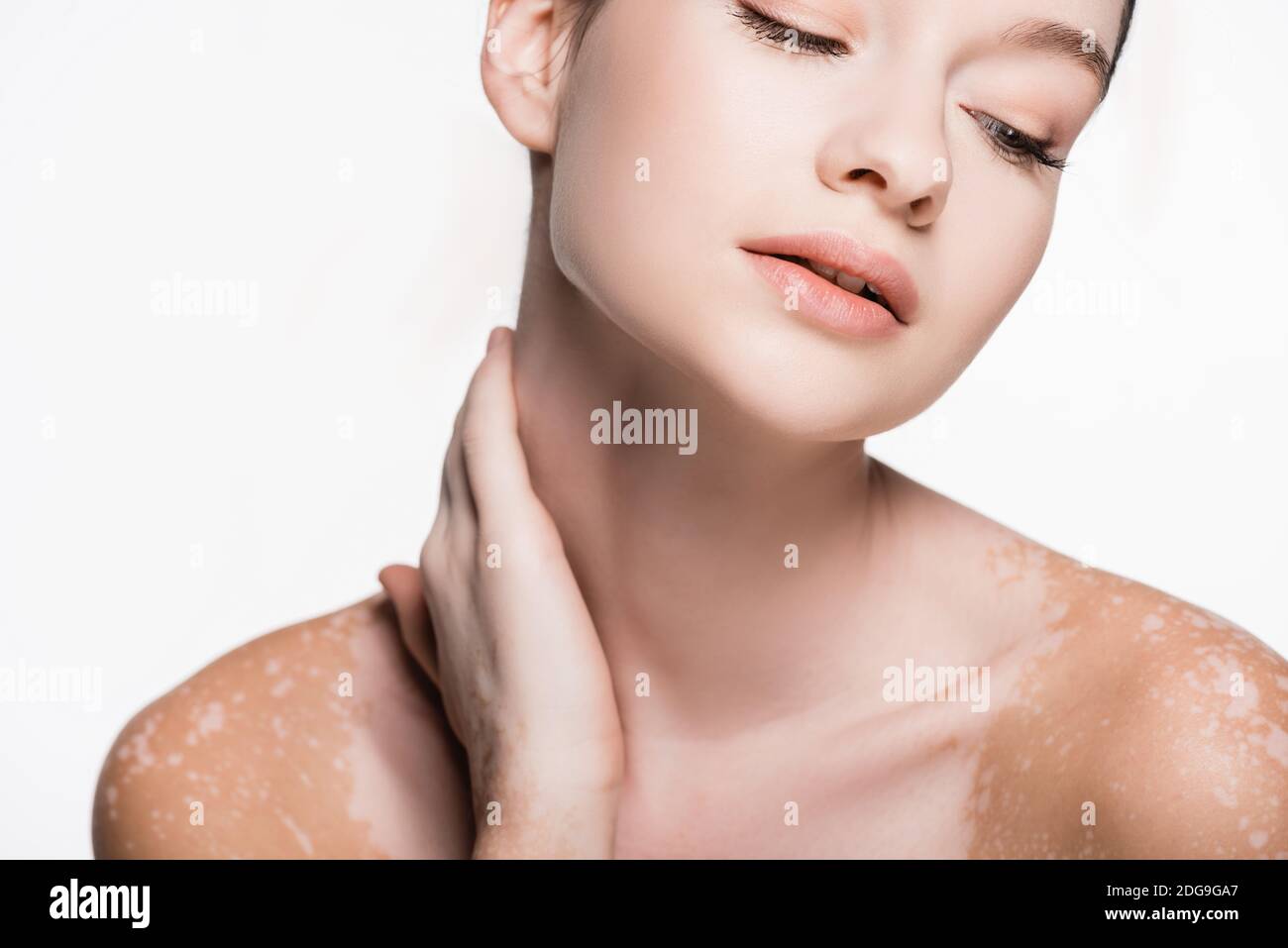 young beautiful woman with vitiligo isolated on white Stock Photo - Alamy