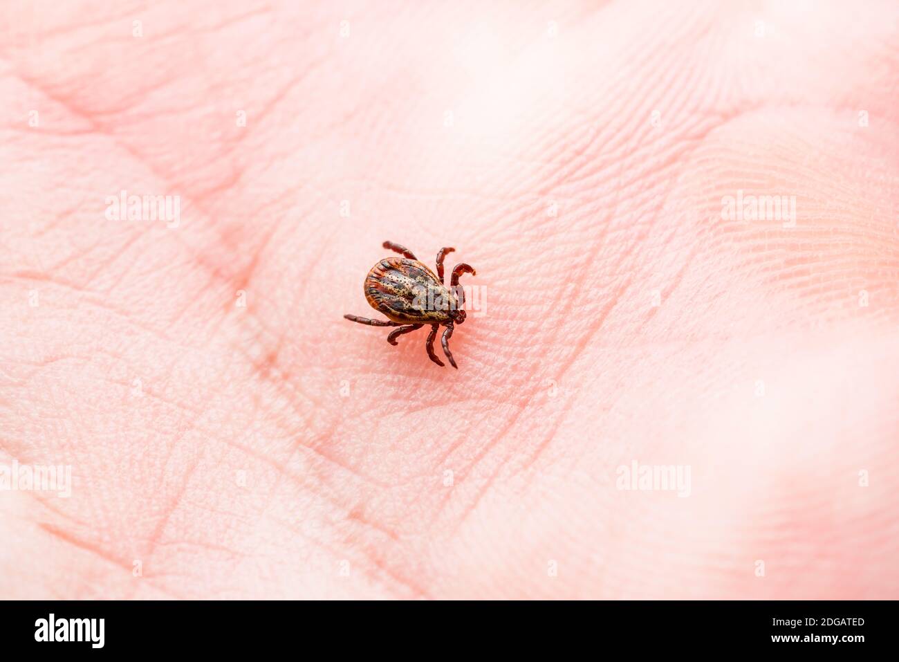 Infectious Encephalitis Tick Insect Crawling on Skin. Encephalitis ...