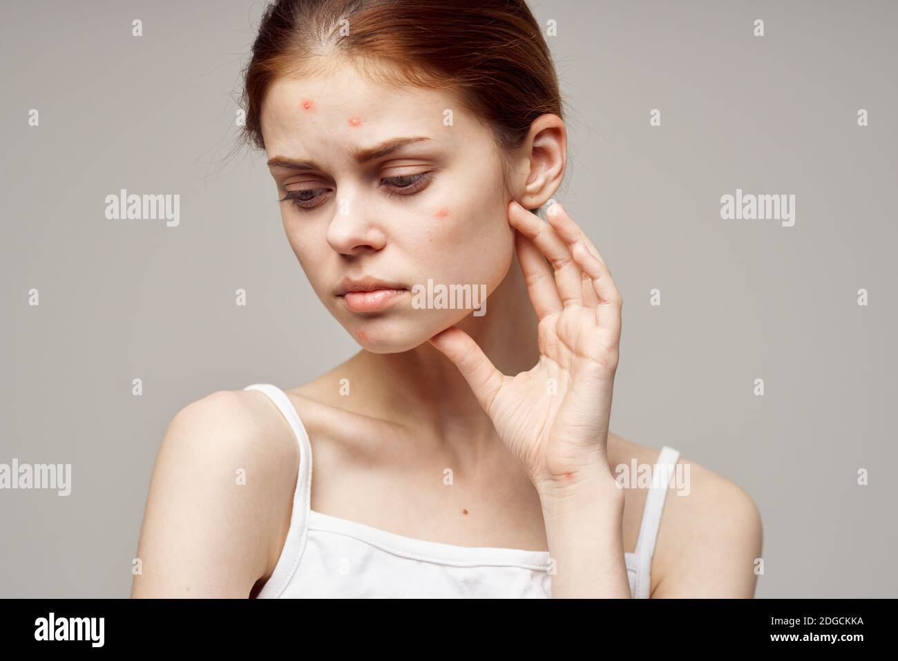 woman face skin problem acne acne portrait cropped view Stock Photo - Alamy