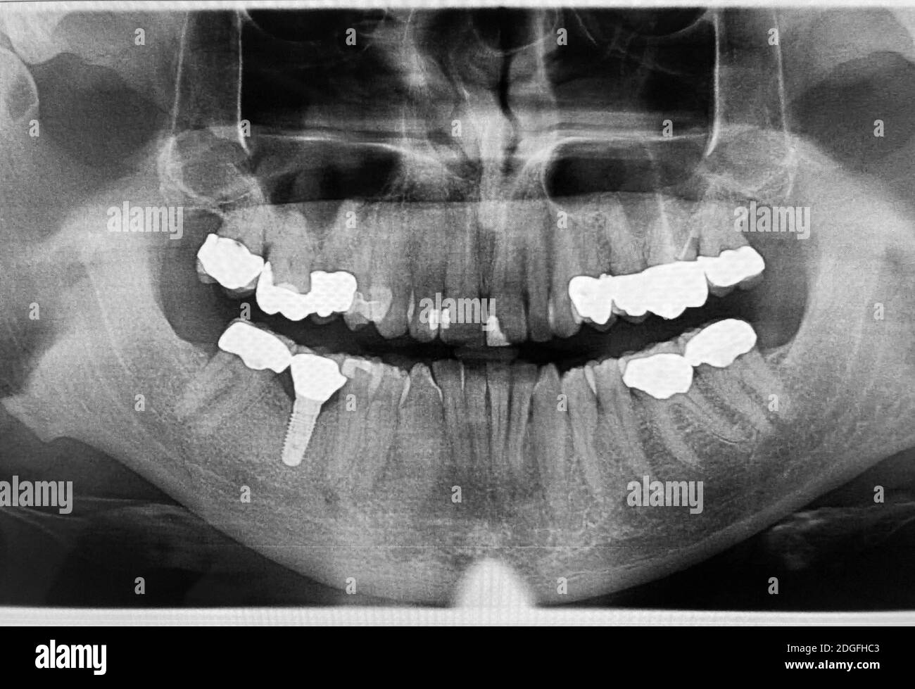 Teeth x-ray picture Stock Photo - Alamy