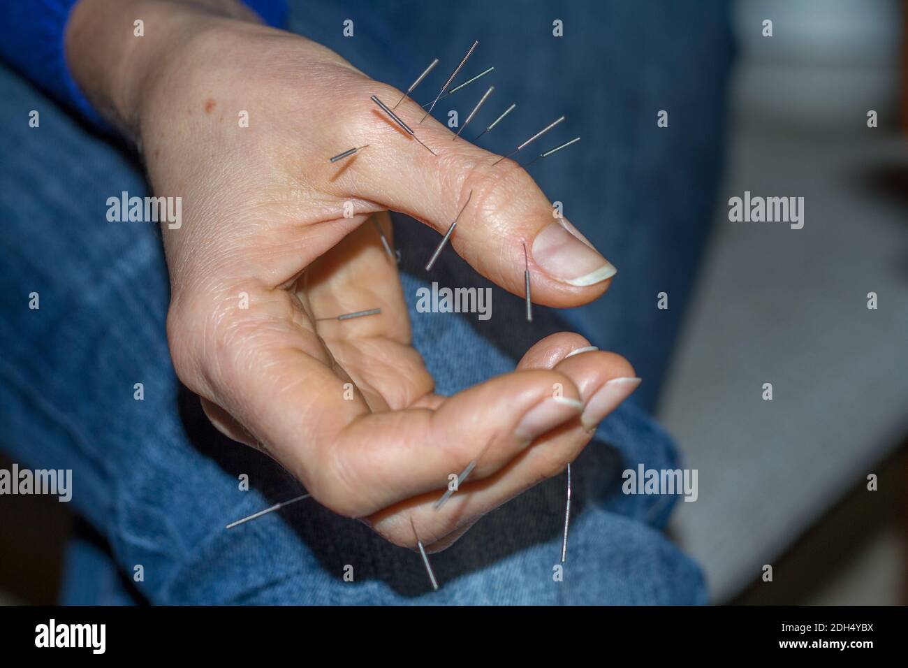 Close-up of female hand with acupuncture needles, alternative ...