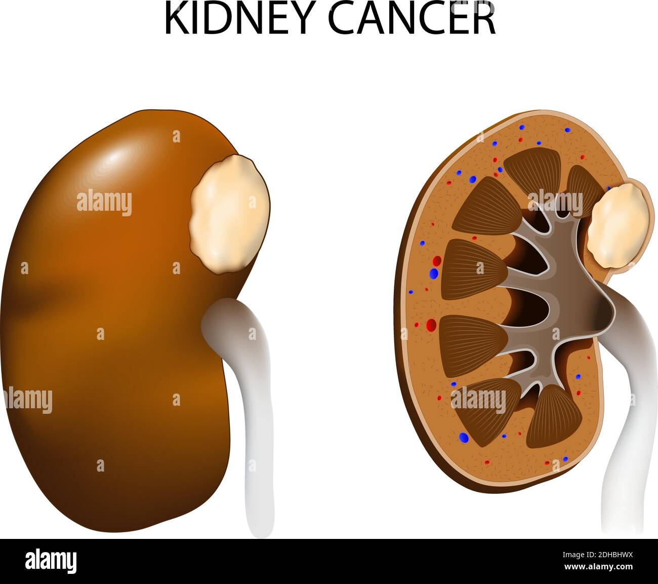 kidney cancer. Cross-section of the human kidney. Vector illustration ...