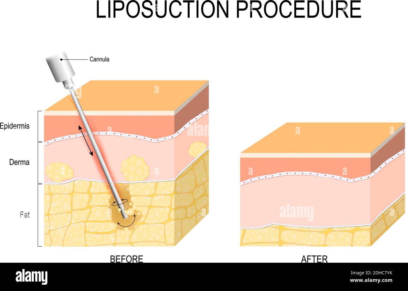 liposuction procedure. Before and after. fat modeling and surgery ...