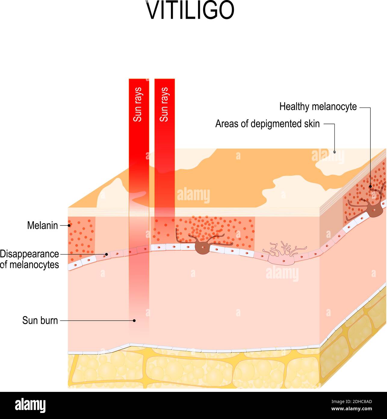 Vitiligo. Is a skin condition characterized by portions of the skin ...