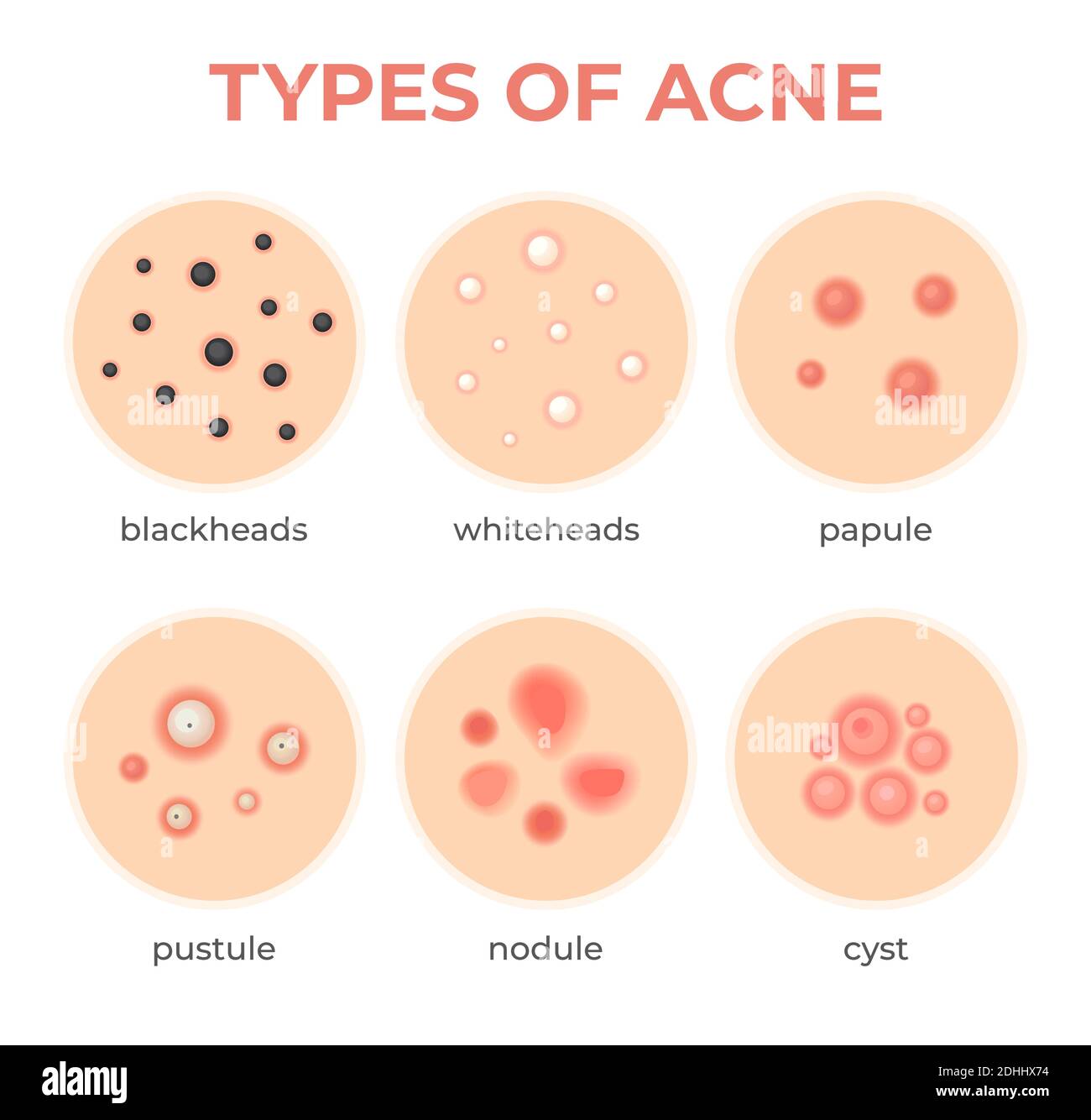 Nodular Acne