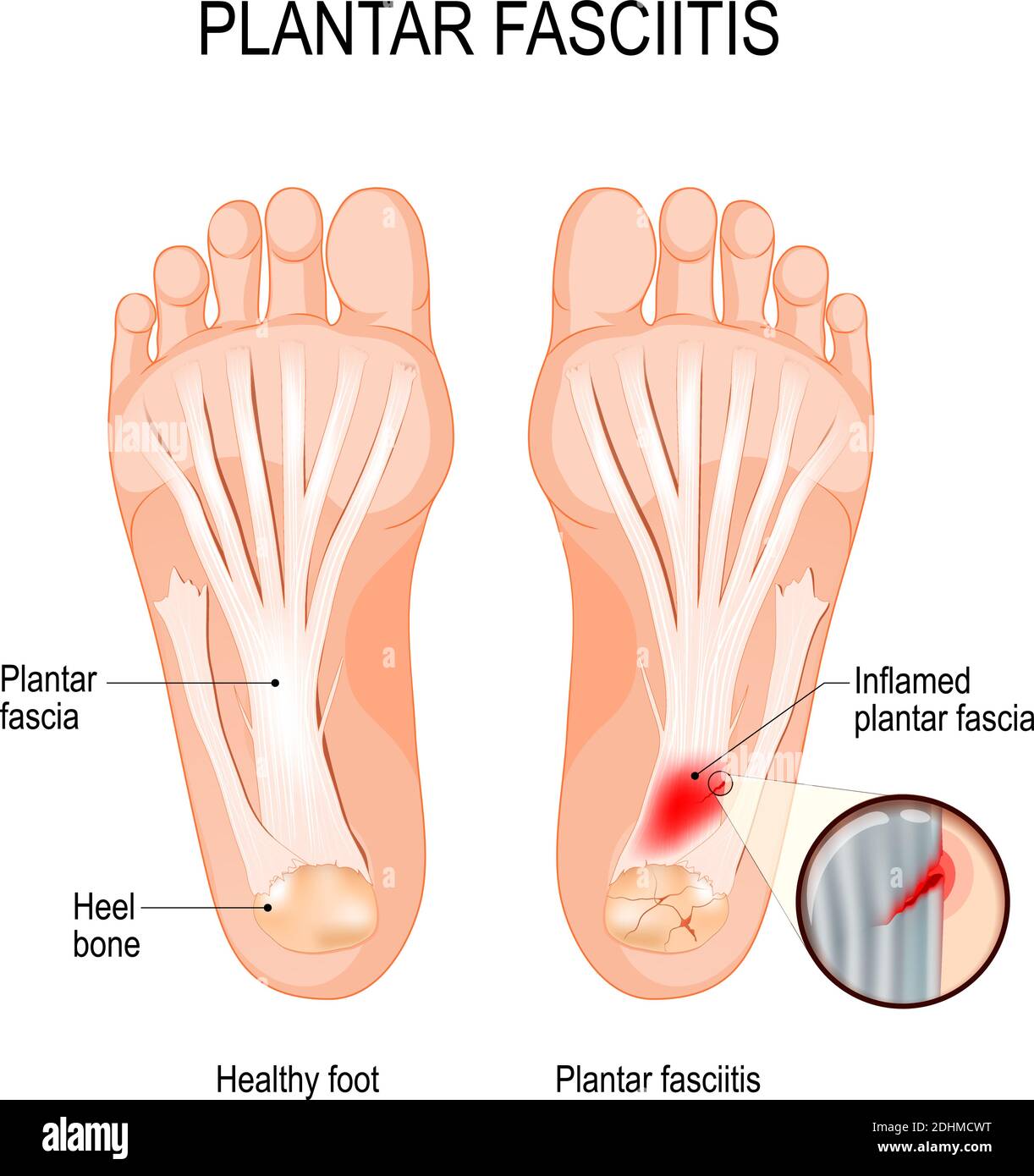 Plantar fasciitis. disorder of the connective tissue which supports the arch of the foot. vector ...
