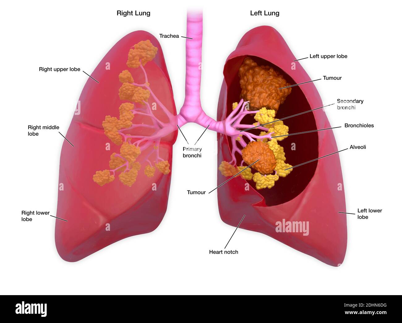 Annotated illustration of malignant (cancerous) tumours in a human lung ...