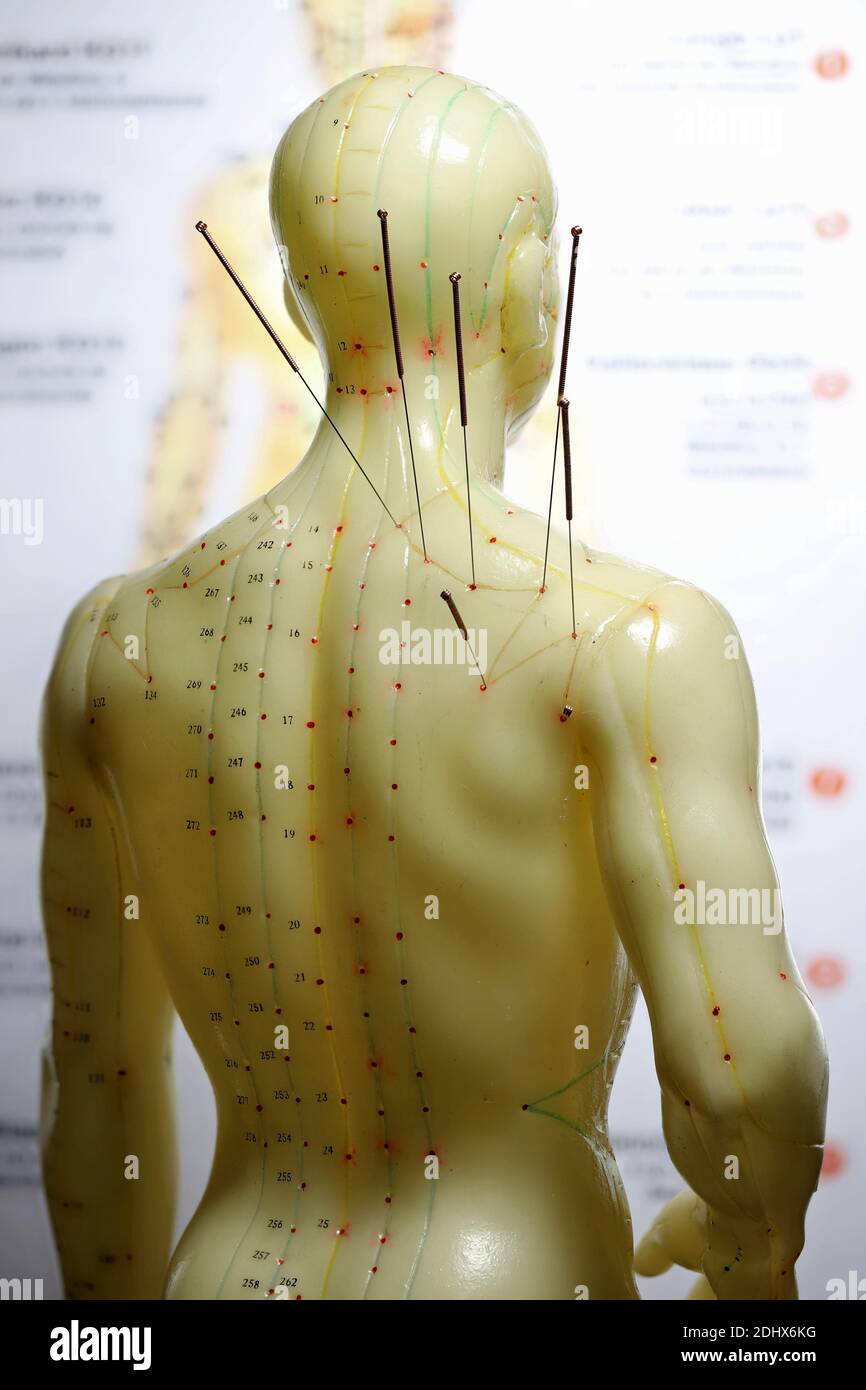 male acupuncture model with needles in the right shoulder Stock Photo ...