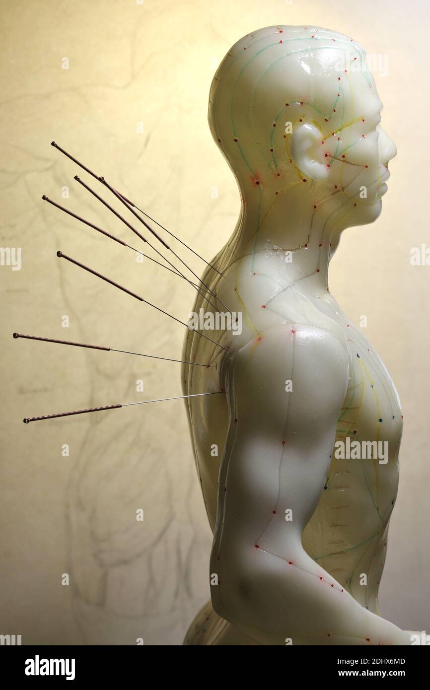 male acupuncture model with needles in the right shoulder Stock Photo ...