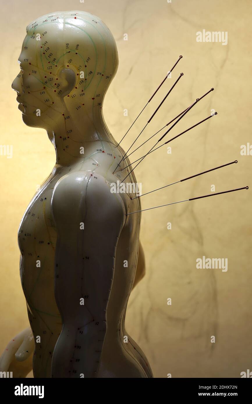 male acupuncture model with needles in the left shoulder Stock Photo ...