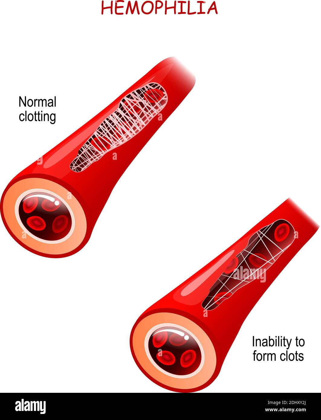 Haemophilia. hemophilia. healthy blood vessel after bleeding and blood vessel with Coagulation ...