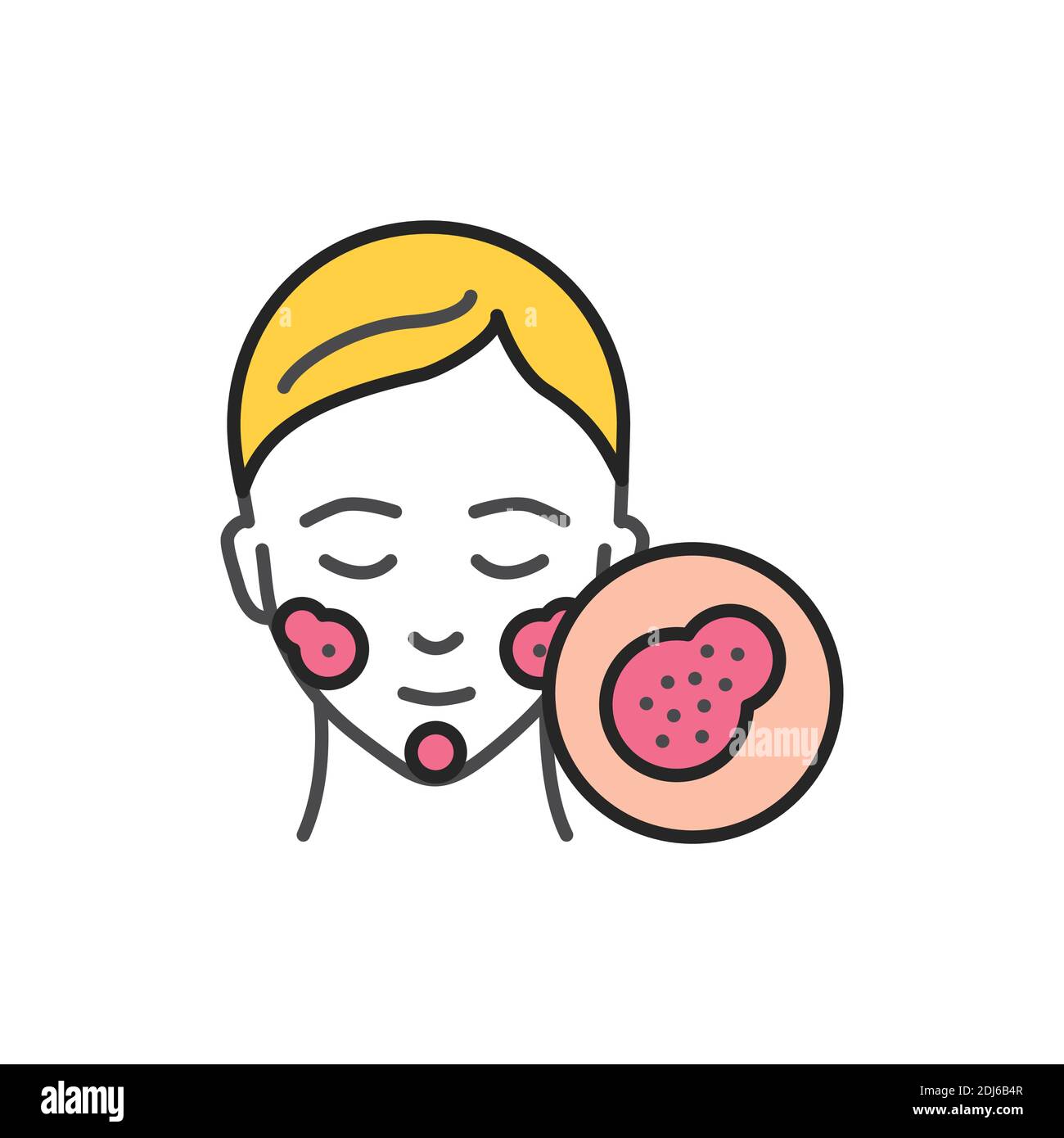 Rosacea And Dermatitis Stock Vector Images Alamy