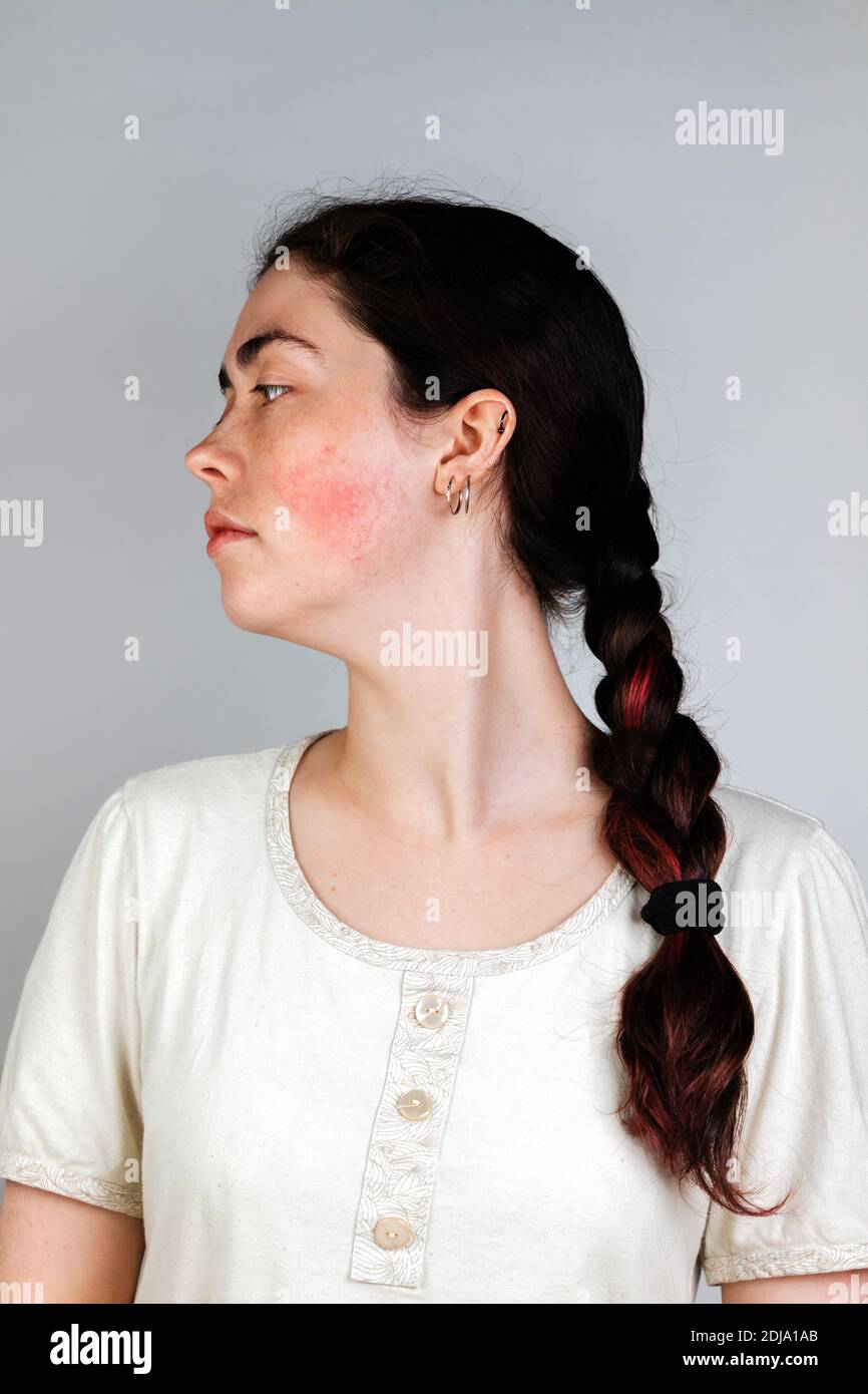 Red cheeks ill hi-res stock photography and images - Alamy