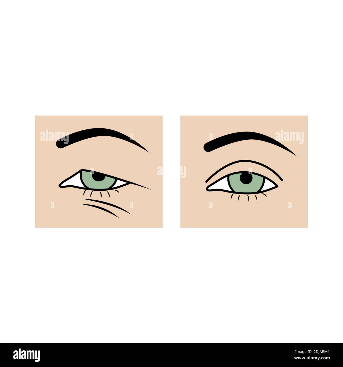 Upper eyelid blepharoplasty before and after, comparison. Drooping ...