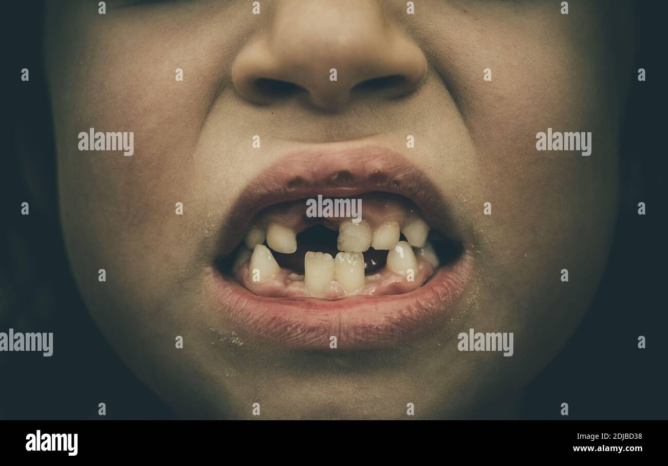 Toothless Child High Resolution Stock Photography and Images - Alamy