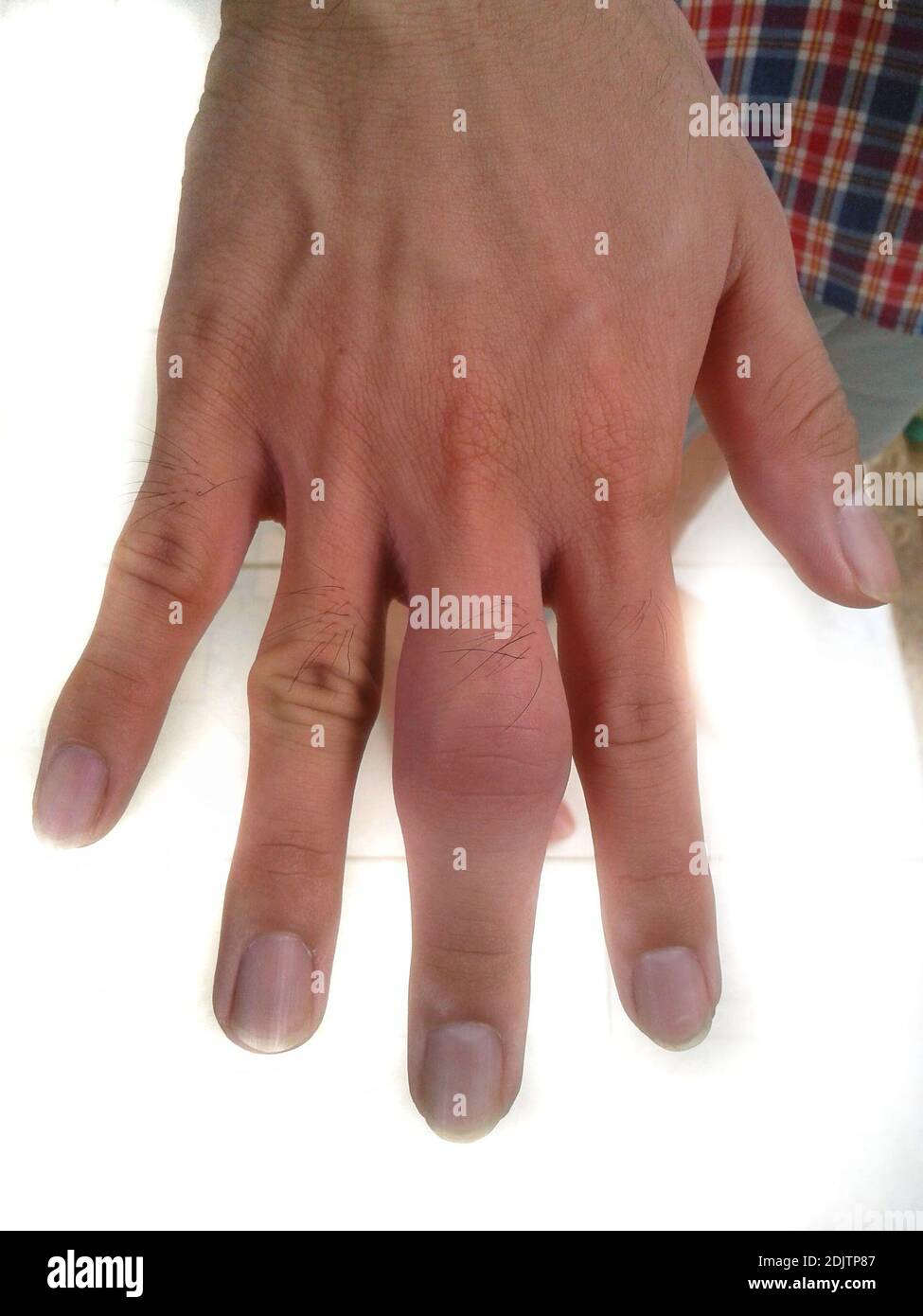 Swollen Finger High Resolution Stock Photography and Images - Alamy