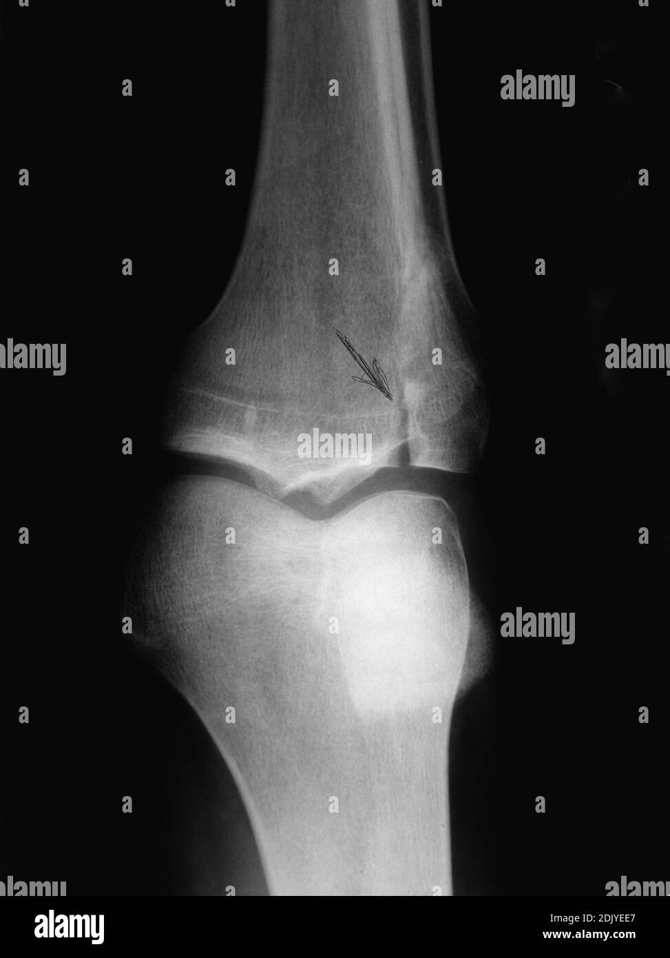 Bone x ray hi-res stock photography and images - Alamy
